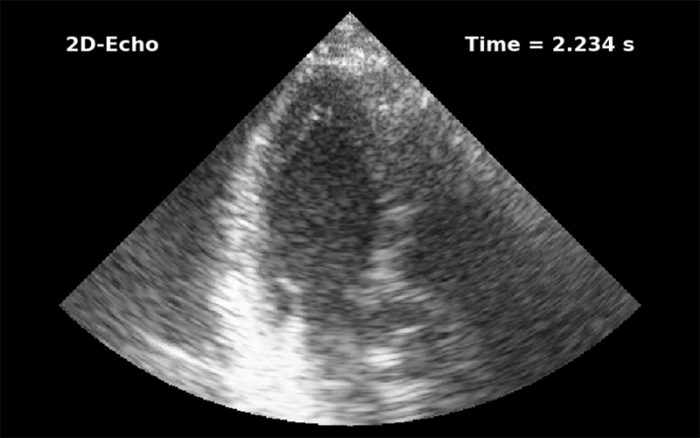 Veocor | Personalized Diagnostic of Stroke Risk